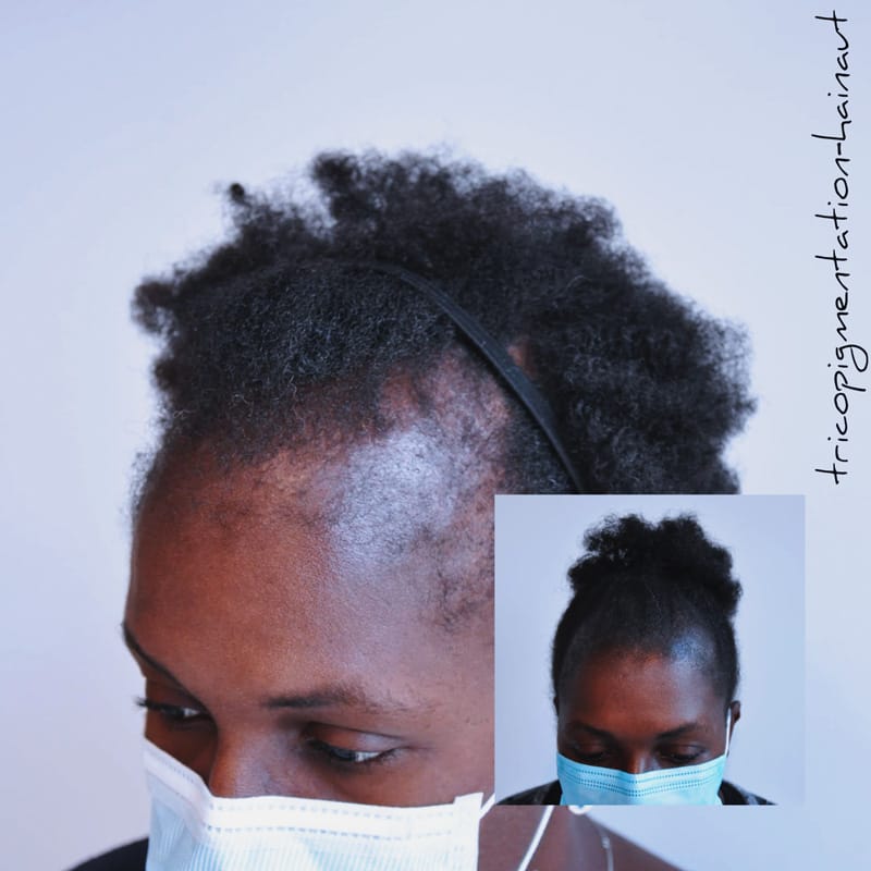 La solution à la calvitie chez la femme