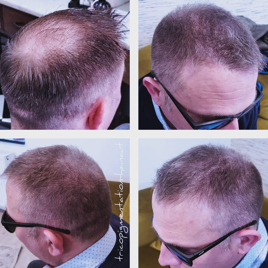 La solution à la calvitie chez l’homme